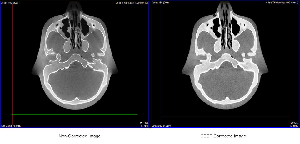 Cone Beam Computed Tomography (CBCT) Rivals Image Quality of Computed ...